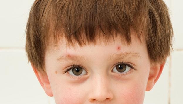 Ospa jak ją leczyć? - Kobieta w INTERIA.PL