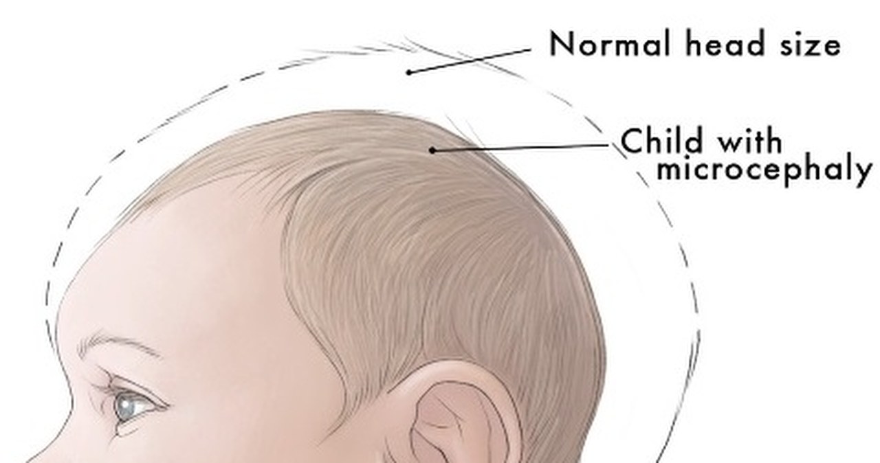 Wirus Zika powoduje małogłowie? Zbliża się epidemia? - GeekWeek w ...