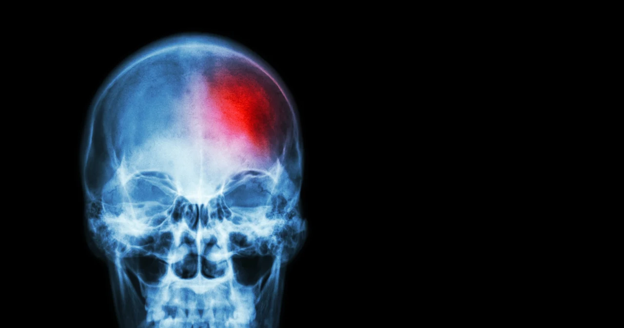 Guz mózgu samoistnie zniknął po porodzie