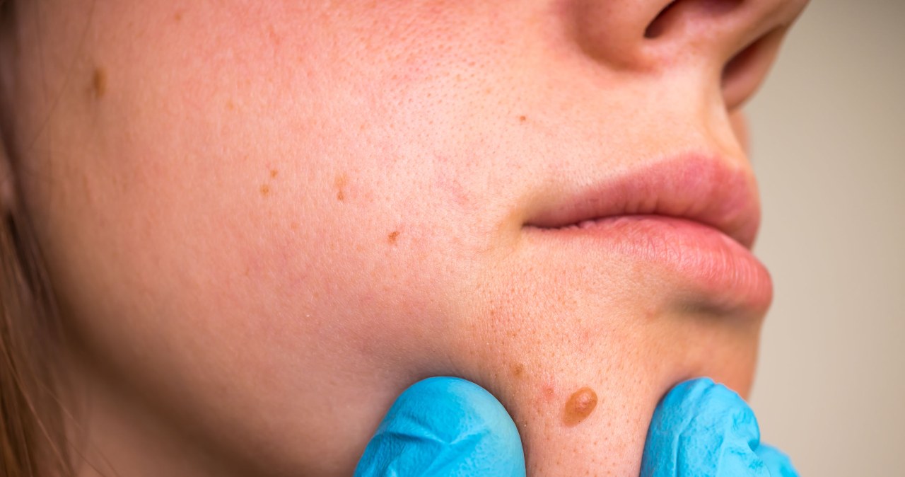 Prosaki i włókniaki: Jak się ich pozbyć? - Kobieta w INTERIA.PL