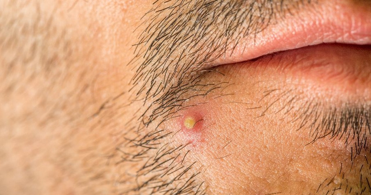 Domowe sposoby na czyraki: Czy są bezpieczne? Jak i kiedy stosować ...