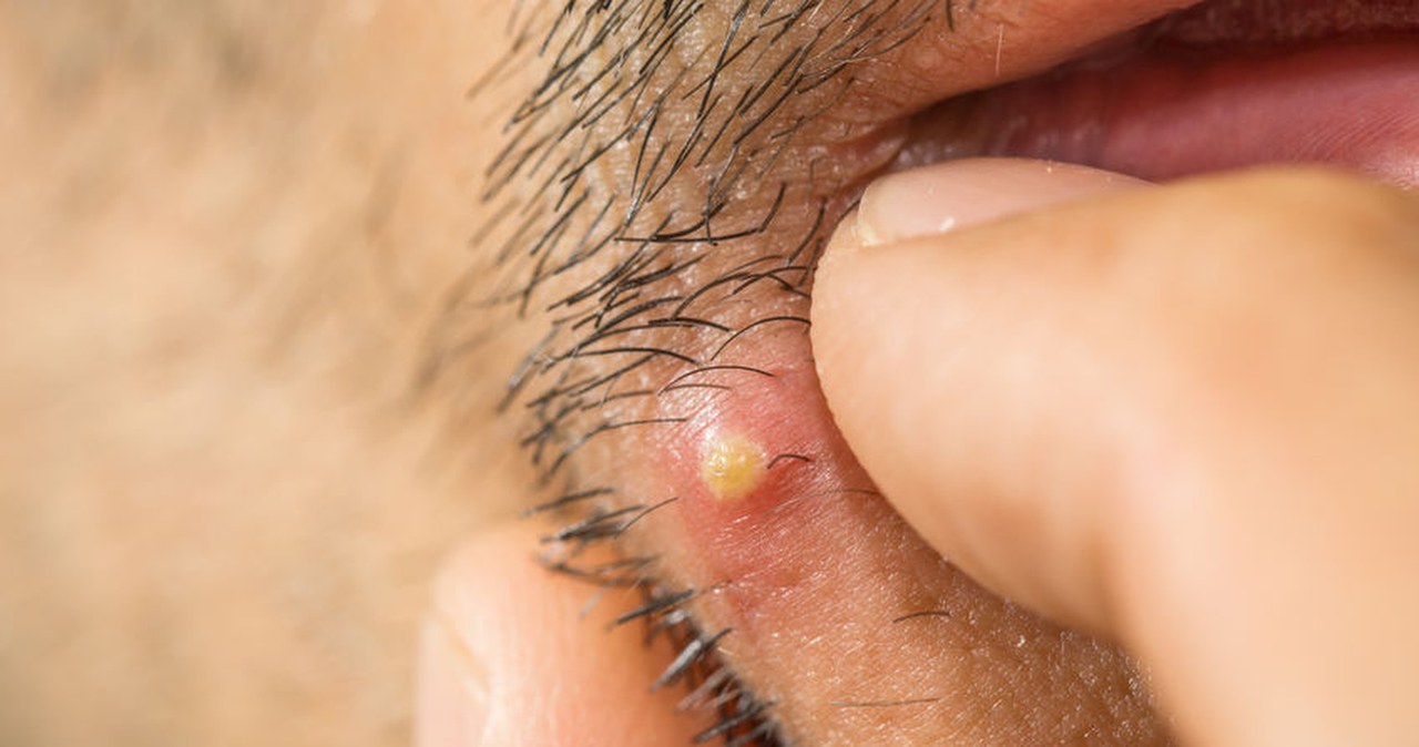 Czyraki: Czym są? Przyczyny, objawy, leczenie - Kobieta w INTERIA.PL