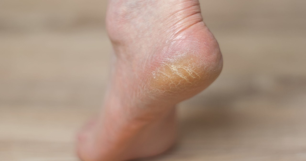 Domowe sposoby na piękne stopy - Kobieta w INTERIA.PL