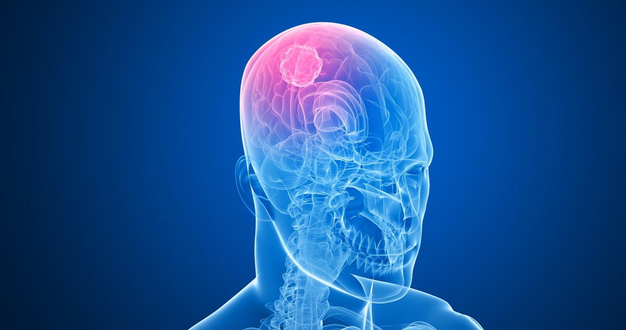 Glejaki - jakie szanse na przeżycie mają chorzy? - Zdrowie w INTERIA.PL