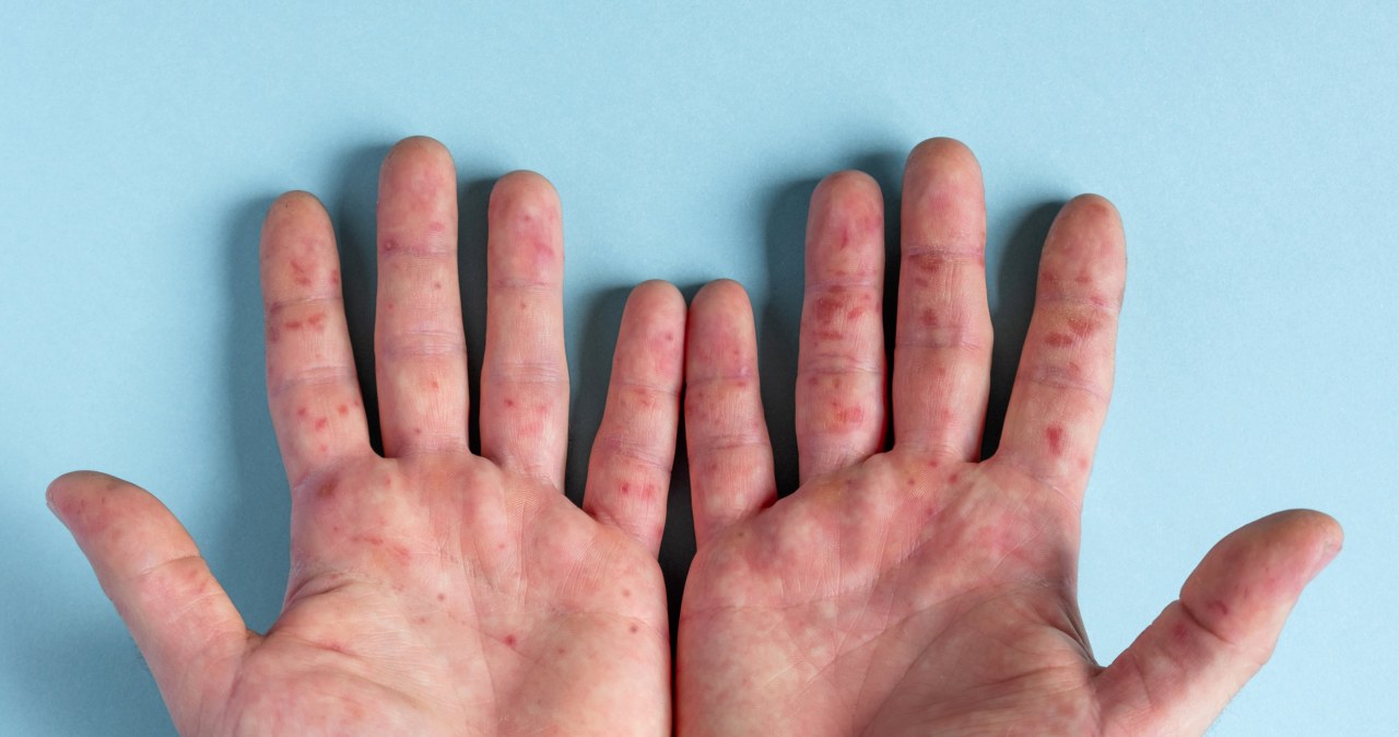 Bostonka: przyczyny, objawy, leczenie - Zdrowie w INTERIA.PL