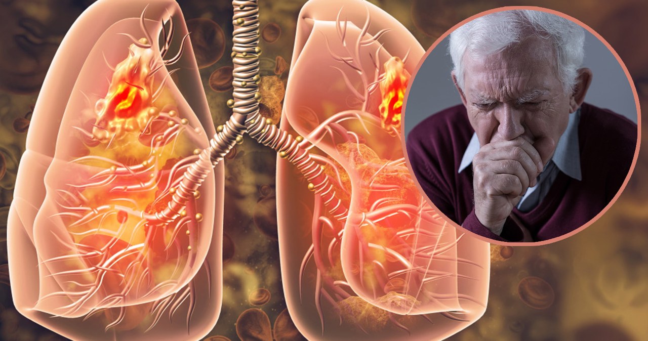 Siedem objawów raka płuc. Kaszel to jeden z nich - Zdrowie w INTERIA.PL