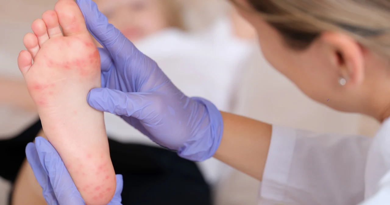 Bostonka: Co to za choroba? Objawy u dzieci i dorosłych. Leczenie ...