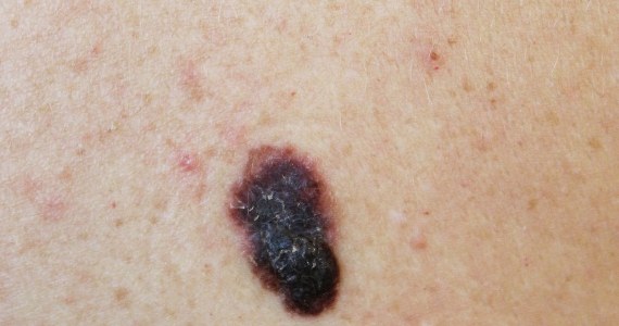 Czerniak. Kto jest szczególnie narażony? - Twojezdrowie.pl
