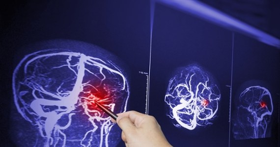 Guz mózgu - jakie może dawać objawy?