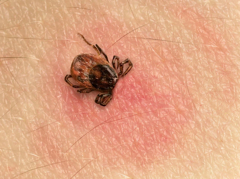 Borelioza: Objawy i dieta wspierająca leczenie - Kobieta w INTERIA.PL