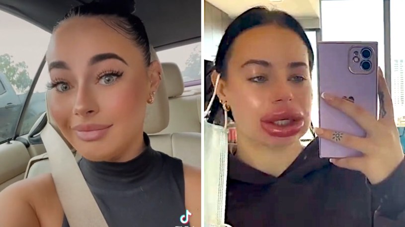 Tiktokerka ostrzega przed "darmowymi zabiegami kosmetycznymi". Pokazała ...