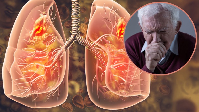 Siedem objawów raka płuc. Kaszel to jeden z nich - Zdrowie w INTERIA.PL