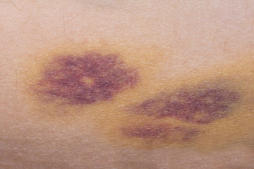 Jak pozbyć się siniaków z ciała? - Kobieta w INTERIA.PL