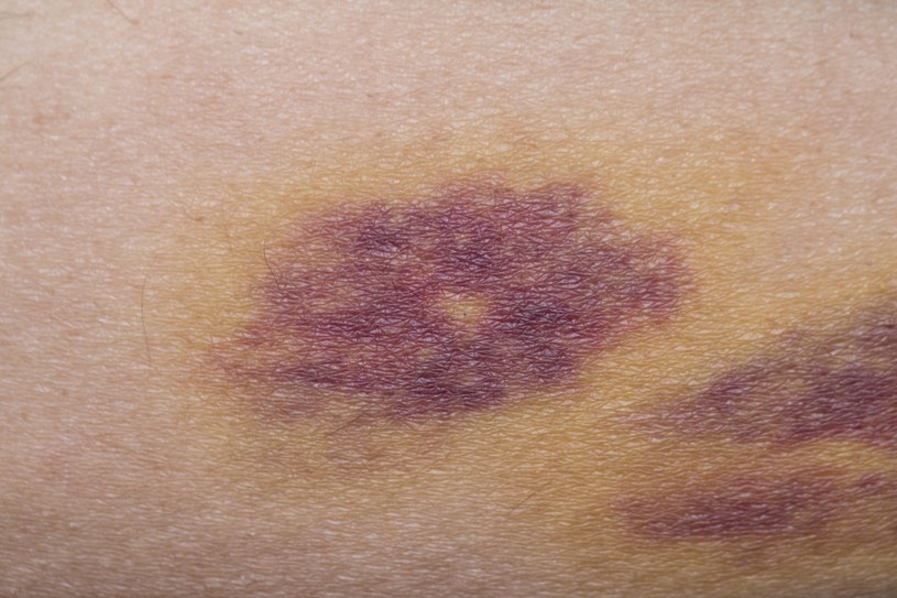 Jak pozbyć się siniaków? Sposoby babci - Porady w INTERIA.PL