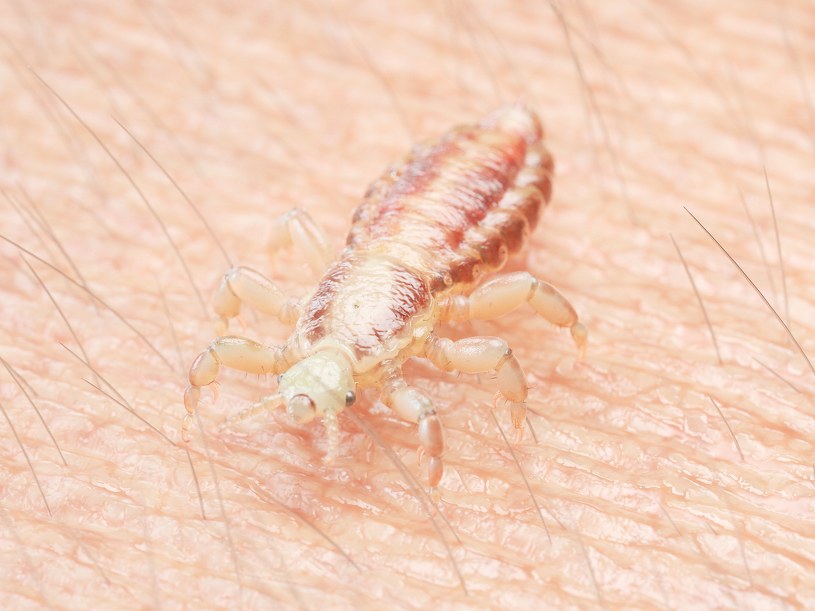 Po czym poznać, że ma się wszy? W ten sposób się ich pozbędziesz - Kobieta w INTERIA.PL