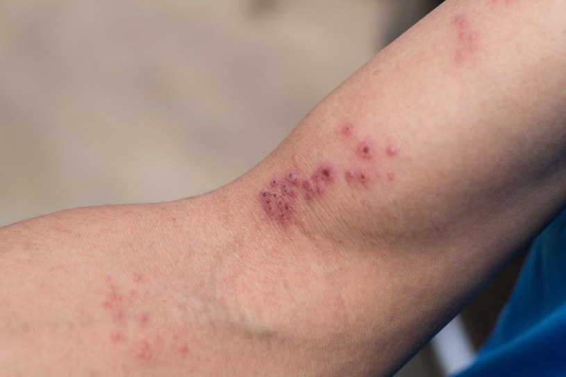 Zmiany na skórze, które są objawem choroby jelit - Porady w INTERIA.PL